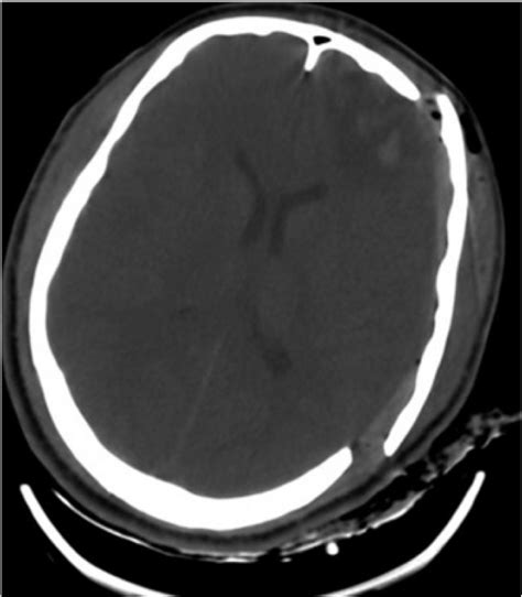 Left Fronto Temporal Decompressive Craniotomy Note Copyright © 2013