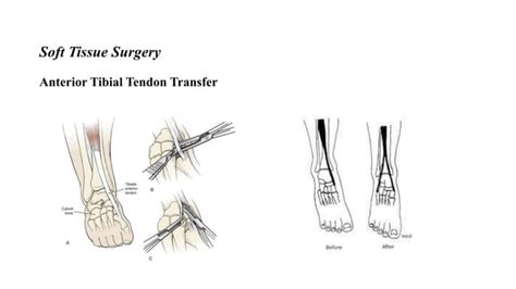 Surgical Treatment Of Ctev Pptx