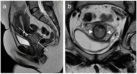 Sagittal T2wi A Shows A Well Defined Intermediate Signal Intensity