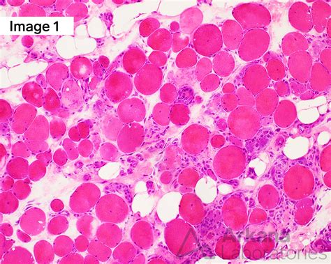 Anti Srp Myopathy Neuro Notes Arkana Laboratories