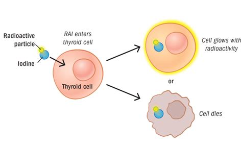 Treatment Options For Papillary Thyroid Carcinoma