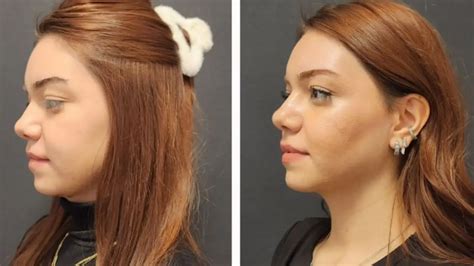 Jaw Bone Mandible Structure Functions And Surgical Period