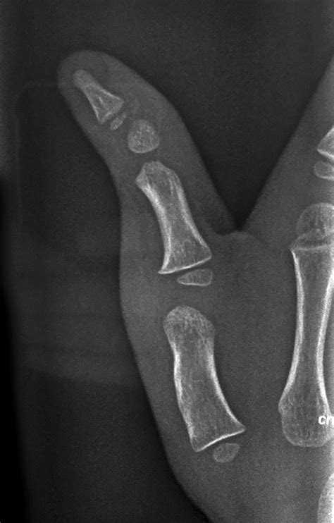 Thumb Deformity Congenital Hand And Arm Differences Washington University In St Louis