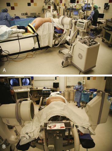 Lumbar Microdiscectomy Indications And Techniques Neupsy Key