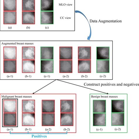 Breast Masses That Are Correctly Classified By Multi‐view Breast Mass Download Scientific