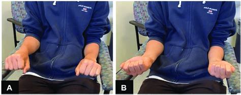 Eight Weeks After 3 Dimensional Guided Ulnar Osteotomy Showing Almost Download Scientific