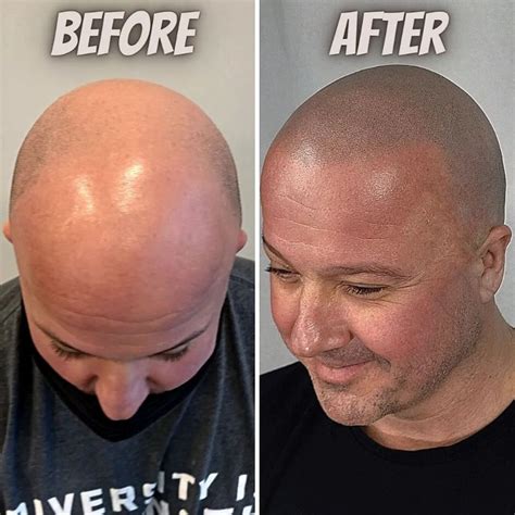 Scalp Micropigmentation Results Gallery Enhanced Scalp