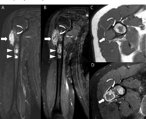 Figure 4 From Classification Of Chondrosarcoma From Characteristic To