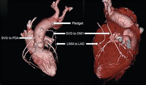 Evaluation Of Coronary Artery Bypass By Ct Coronary Angiography