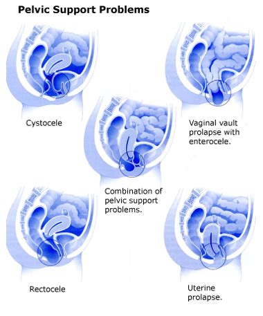 Uterovaginal Prolapse