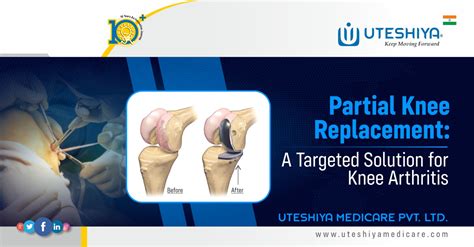 Partial Knee Replacement A Targeted Solution For Knee Arthritis