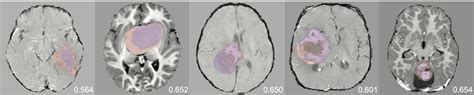examples of predicted blue vs expert red segmentations at 17 5 of
