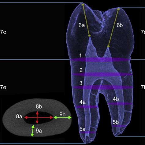 Frequency And Distribution Of Apical Ramifications And Accessory