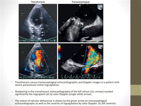 Assessment Of Prosthetic Valve Function Pptx