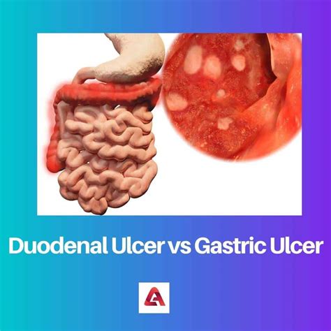 Úlcera Duodenal Vs úlcera Gástrica Diferencia Y Comparación
