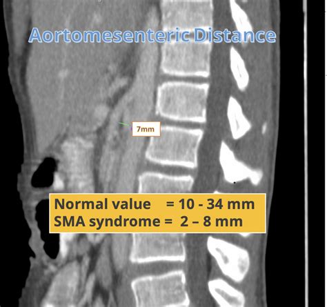 Superior Mesenteric Artery Syndrome Radiology Reference