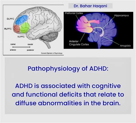 Bahar Haqani On Linkedin 🔵pathophysiology Of Adhd Adhd Is Associated