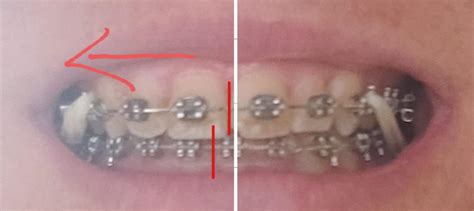 Midline Concern Question In Comments Scrolller