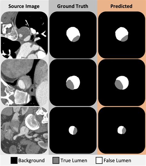 Ct Based True And False Lumen Segmentation In Type B Aortic Dissection