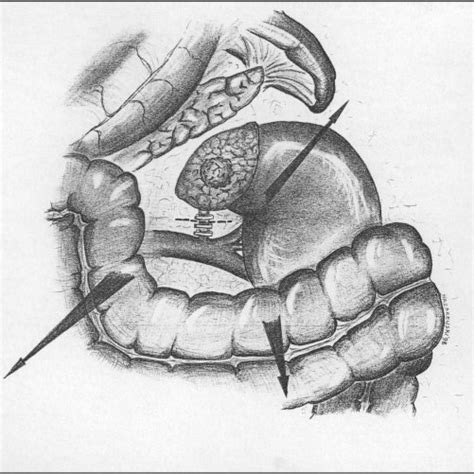 The Right Triangular Ligament Is Divided And The Hepatic Lobe Is