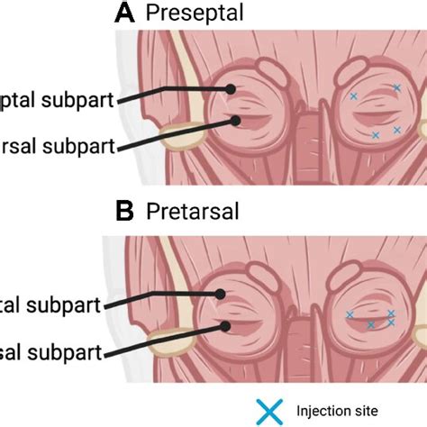 Botulinum Toxin Injection Techniques And Location Of Injection A Download Scientific Diagram
