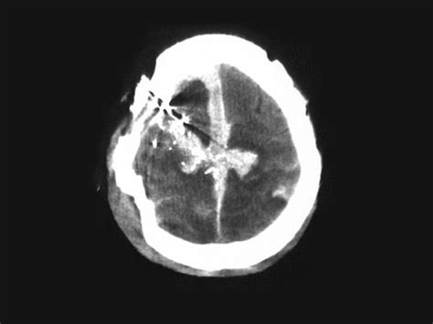 New Tool May Help Predict Survival After Gsw To The Head