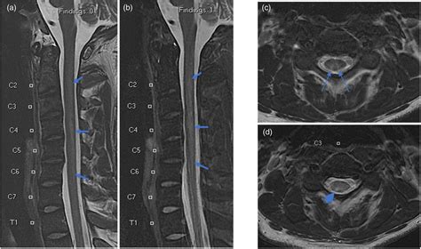 Nitrous Oxide Induced Subacute Combined Degeneration Of The Spinal Cord