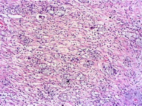 Figure 1 From Goblet Cell Carcinoid Of The Appendix And Mixed
