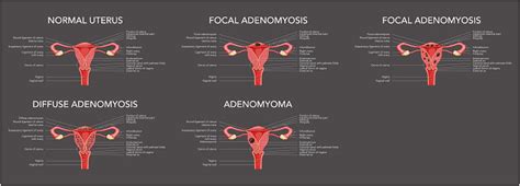 Adenomyosis의 세트 비문 텍스트와 인간의 해부학 여성 생식 아픈 시스템 기관 의료 위치 계획 자궁 자궁 경부 난소 나팔 관 아이콘 벡터 격리 된 그림 자궁에 대한