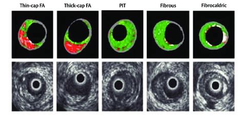 Virtual Histology By Ivus Showing Different Types Of Plaque Morphologies Download Scientific