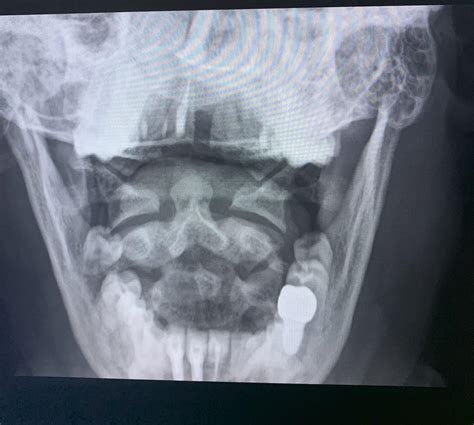 Odontoid Chefs Kiss R Radiology