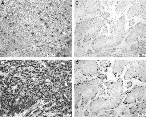 A And B In Situ Tunel For Apoptotic Cells A And Mib 1 Staining For