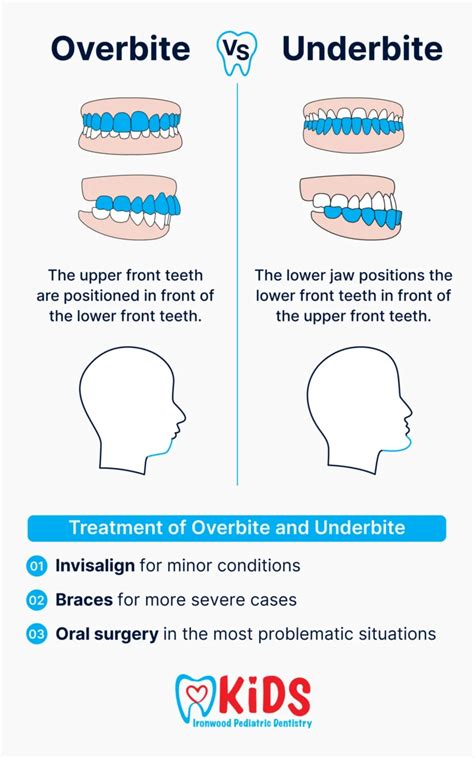 Overbite Vs Underbite