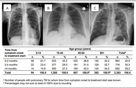 When To Consider Tuberculosis Bronchiectasis In The Elderly Population Bmj Case Reports