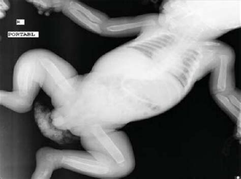 Diff Use Cortical Thickening Hyperostosis And Periosteal Reaction
