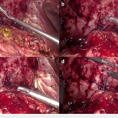 Jejunotomy Closure With Continuous 2 0 Polyglactin Sutures Download Scientific Diagram