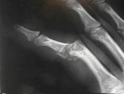 Volar Pip Dislocation Wheeless Textbook Of Orthopaedics