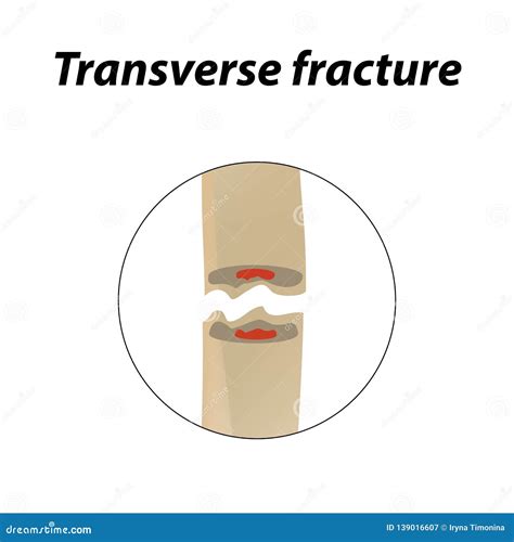 Transverse Bone Fracture Infographics Vector Illustration On A Lined Background Stock Vector