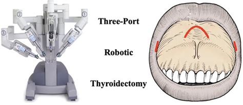 Three‐port Transoral Robotic Thyroidectomy Without Axillary Incision A