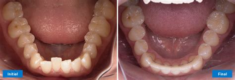 Class I Crowding Shallow Overbite Suresmile® Aligners South Africa