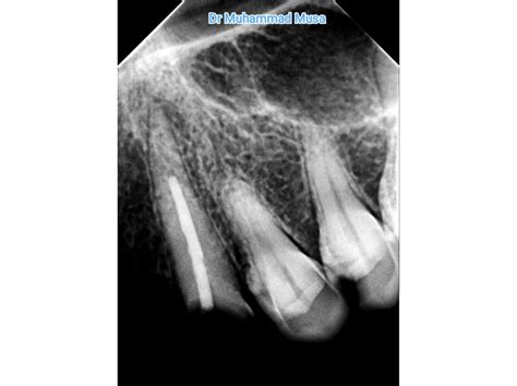 Re Endo Of 23 With Symptomatic Apical Periodontitis Gp Retrieves Using