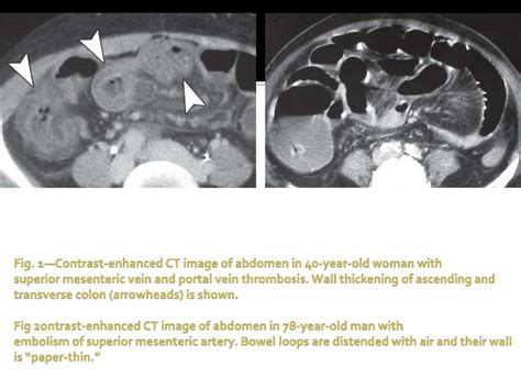 Ct Diagnosis Of Acute Mesenteric Ischemia From Various Causes