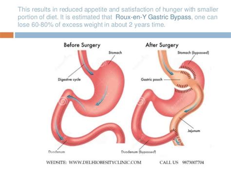 Roux En Y Gastrojejunostomy Procedure