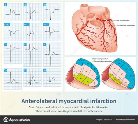 Proximal Segment Left Circumflex Artery Occluded Causes Lateral