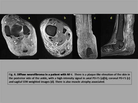 Diffuse Neurofibroma In A Patient With Nf I Download Scientific Diagram