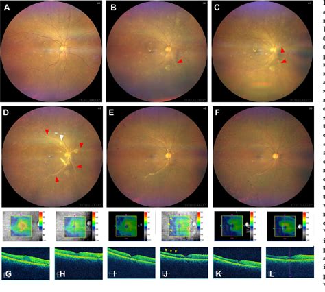 Figure 1 From Retinal Arterial Occlusive Vasculitis After Multiple Intravitreal Brolucizumab