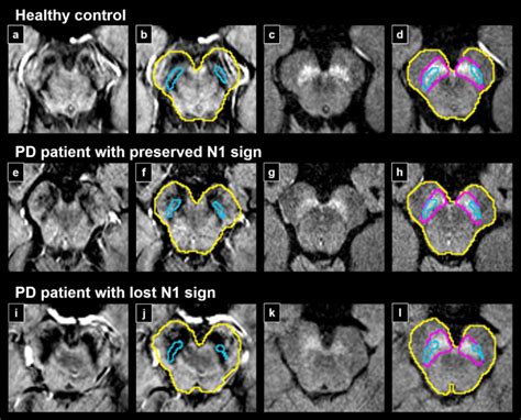 example segmentations of n1 and snc representative segmentations of a