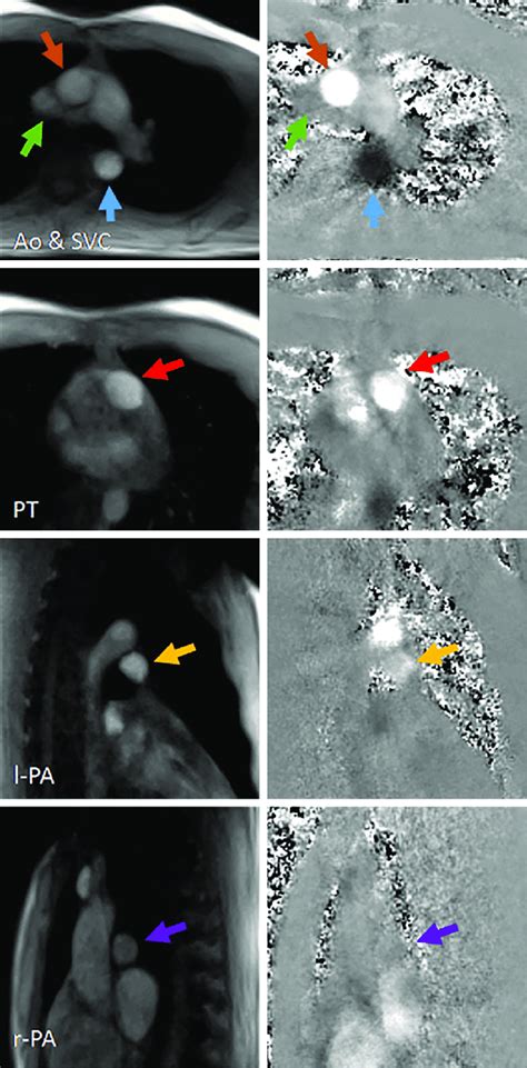 Real Time Phase Contrast Flow Mri 3 T 40 Ms Magnitude Images And Download Scientific