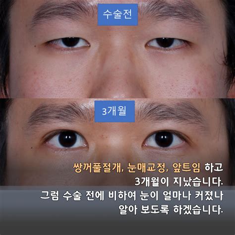 남자눈매교정 수술 전후를 비교해 보아요 눈매교정 눈성형의 모든것 비씨아이 성형외과