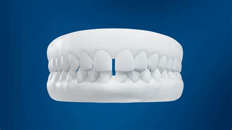 Spacing Reveal Clear Aligners Au